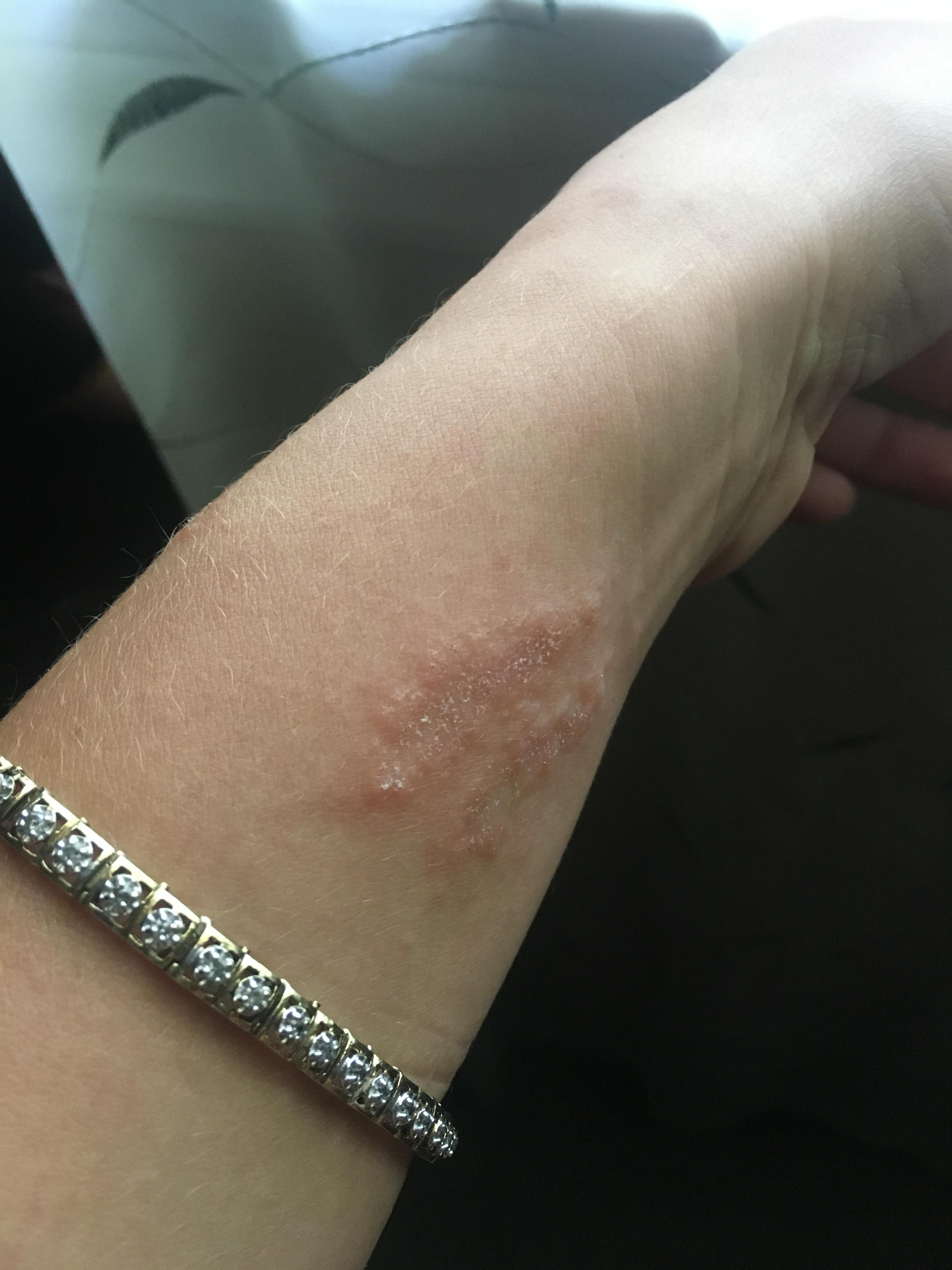 Strange bite, sting, or poison mark. Need help identifying! - Science ...